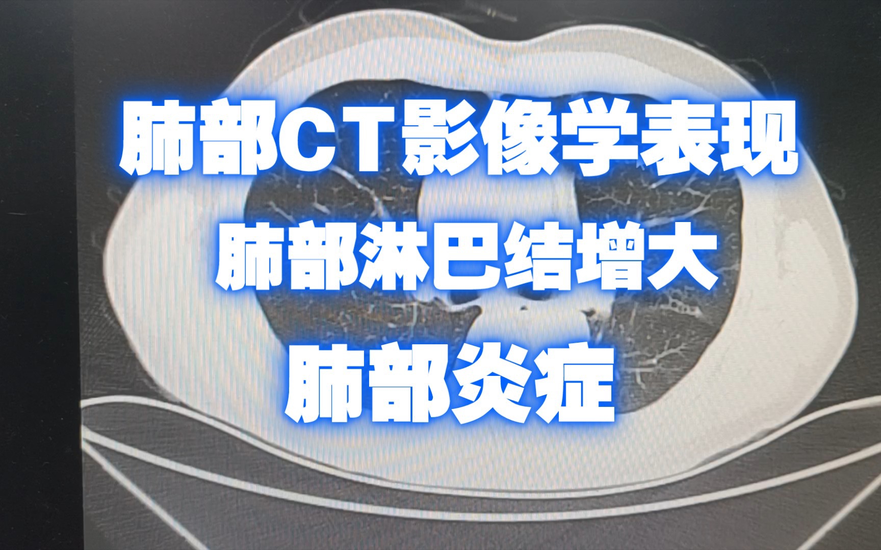 【肺部炎症、肺部淋巴结增大等】CT影像学表现_哔哩哔哩_bilibili