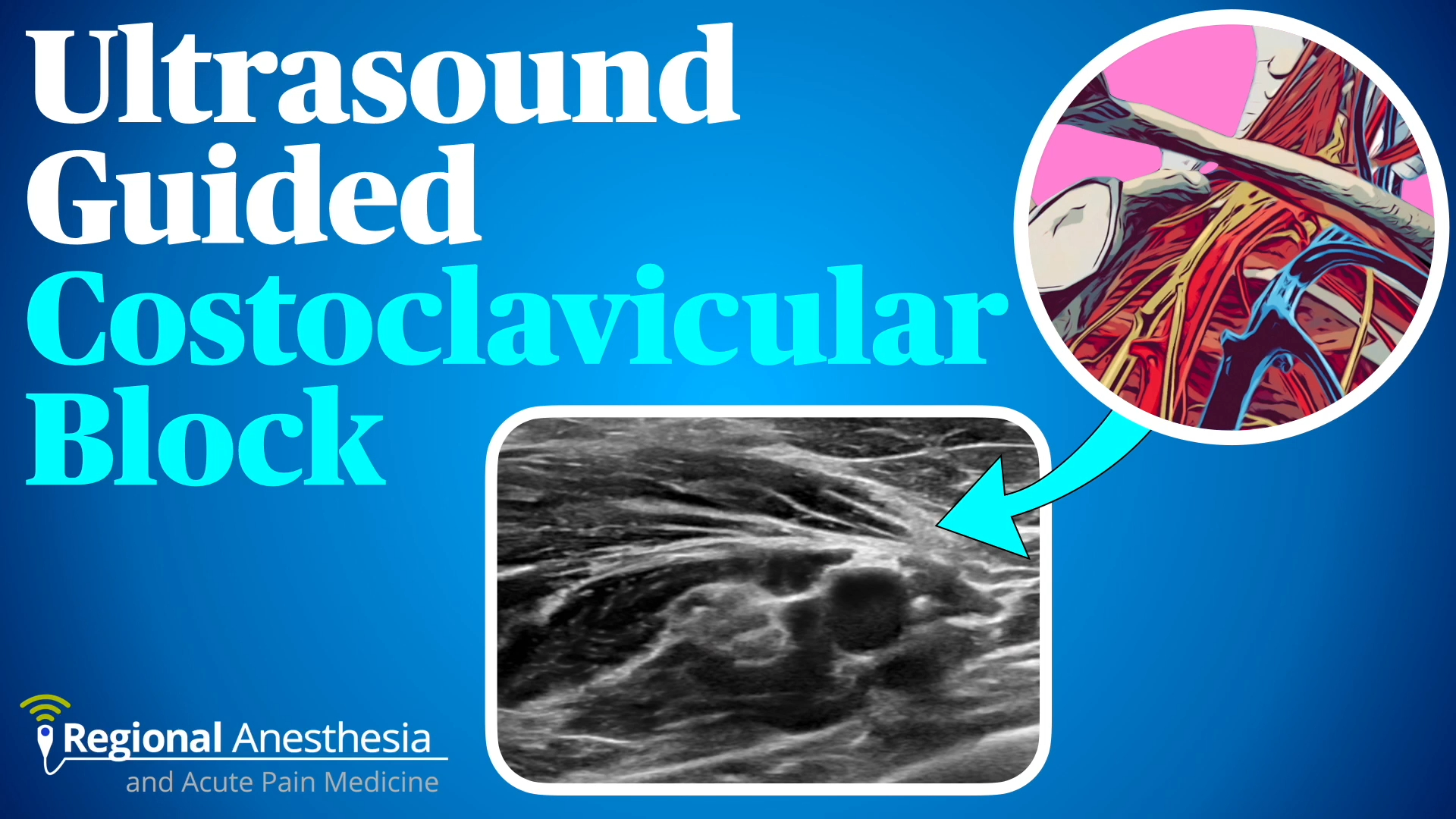 超声肋锁间隙臂丛阻滞Costoclavicular Brachial Plexus Block-bilibili(B站)无水印视频解析——6li6在线工具箱