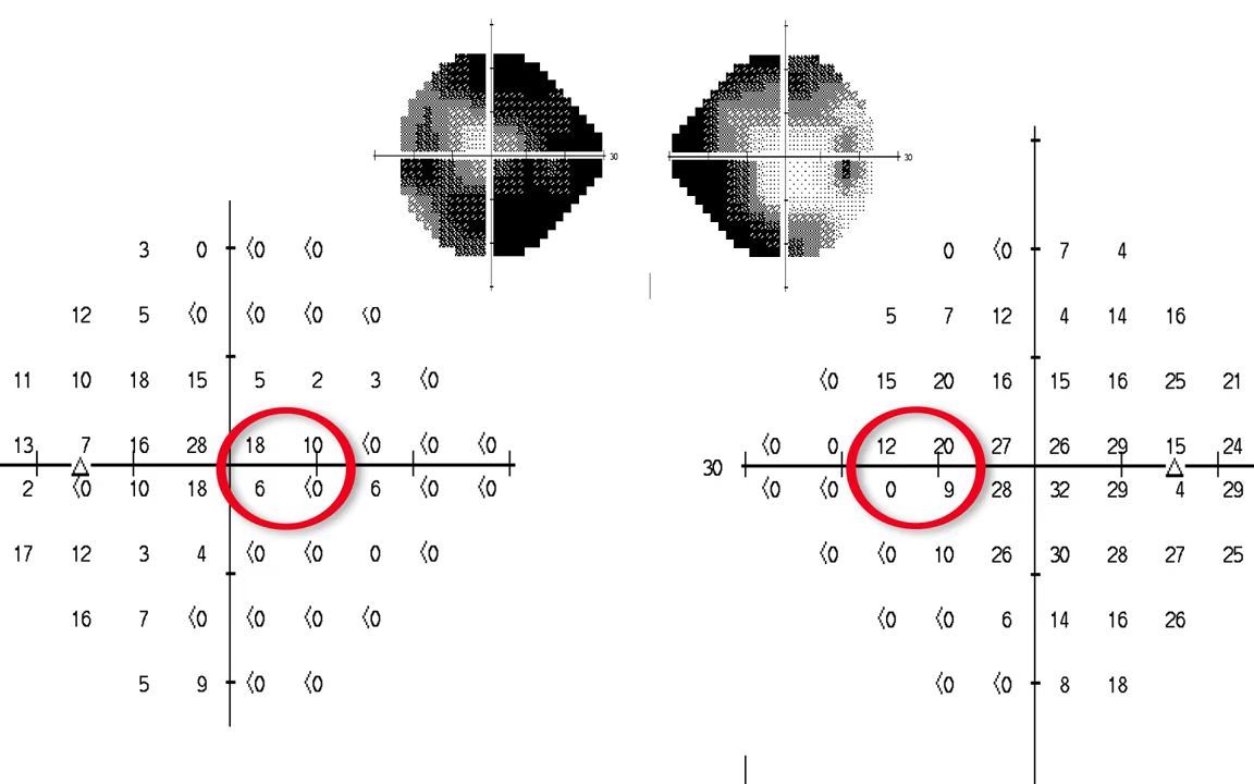 RS Visual Fields Part 4：Dealing With The Constricted Field-视野检查第四部分：_哔哩 ...