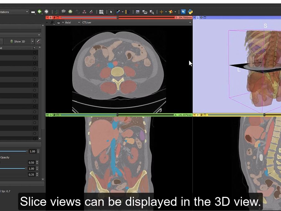 快准狠！在3D Slicer中，使用TotalSegmentator扩展可在1分钟内自动分割全身117个器官-Tina姐吖-Tina姐吖-哔哩哔哩视频