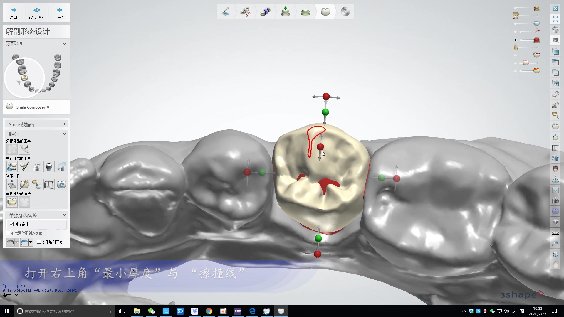 如何用3shape软件设计下颌5号牙_哔哩哔哩 (゜-゜)つロ 干杯~-bilibili