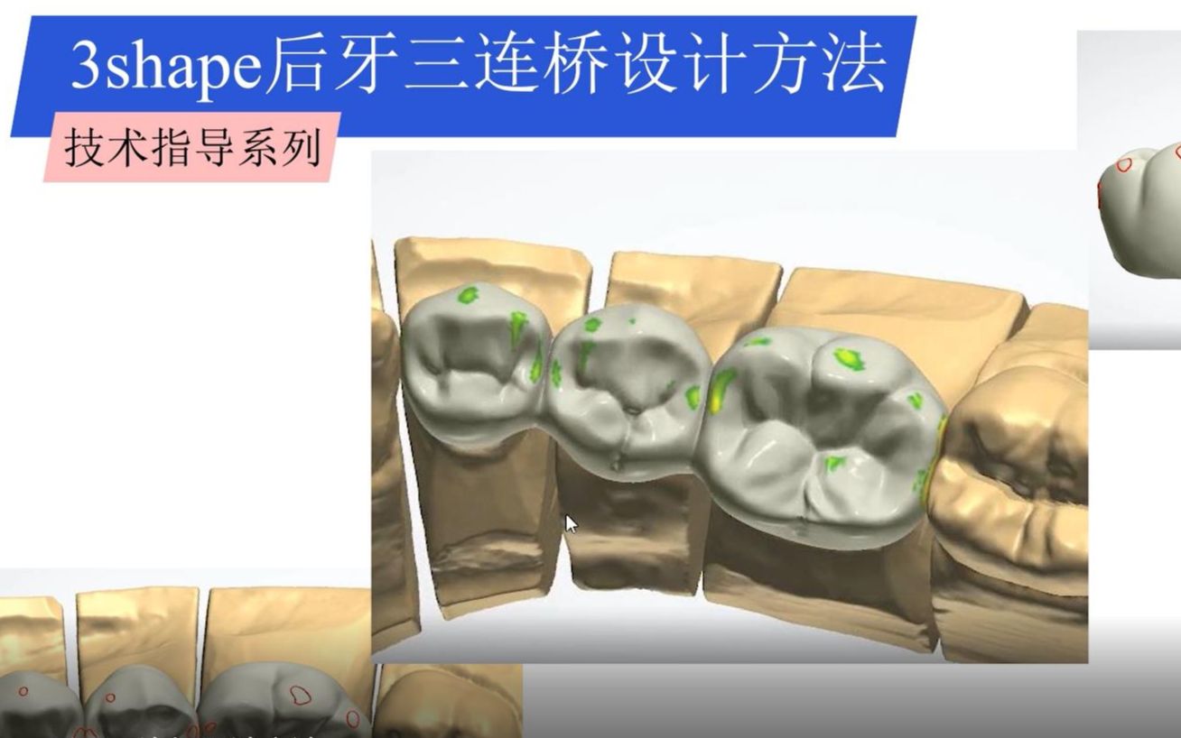 牙宝带你学习如何使用3shape软件设计后牙三连桥_哔哩哔哩_bilibili