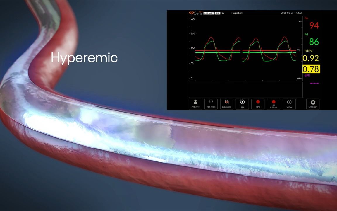 OpSens Medical的OptoWire压力导丝_哔哩哔哩_bilibili