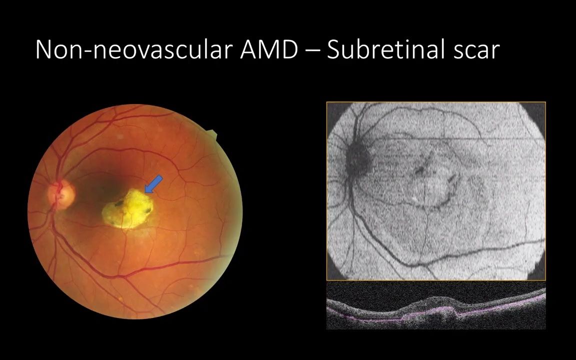 Sturctural EnFace OCT - Choroidal vascular and Bruch's membrane ...